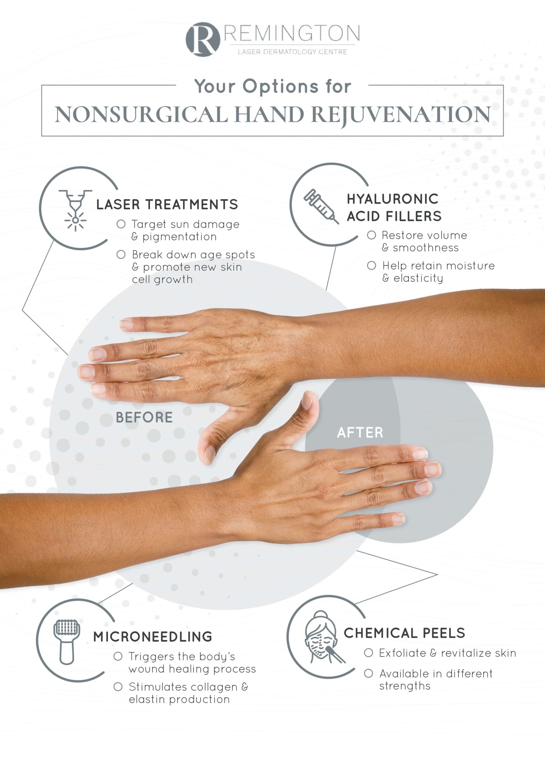 What Is Hand Rejuvenation? | Remington Laser | Calgary